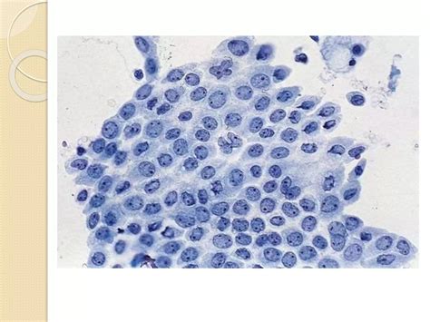 Mesothelial Hyperplasia Ppt