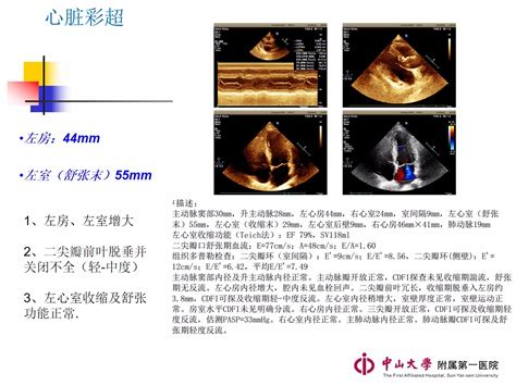 参赛病例85 马跃东左后乳头肌室早 严道医声网