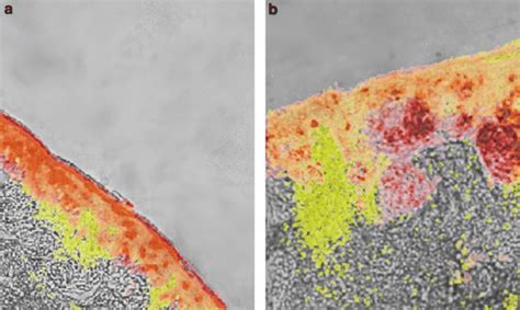 representative results obtained in primary melanoma tissue sections for