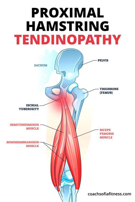 Hamstringtendonitis Rehab Exercises For Relief An Tâm