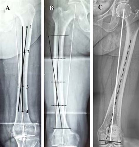 Figure 4 From How Common Is Extra Articular Knee Deformity How To