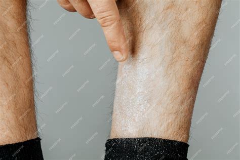급성 건선은 자가면역 난치성 피부과 피부병이며 크고 붉은 염증이 있는 발진 건선 관절염에 의해 영향을 받는 관절 프리미엄 사진