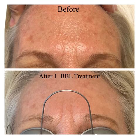 Sciton Bbl Laser Dermatology Care Of Charlotte Dermatology Care Of