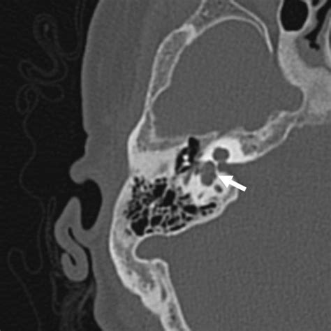Cochlear Incomplete Partition Type Ii And Large Vestibular Aqueduct