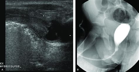 Ambiguous Genitalia Ultrasound