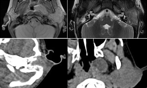 Pre Operative Imaging Of The Patient Upper Left Axial Mri T1 With No
