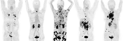 New Radiotracer Can Identify Nearly 30 Types Of Cancer Ge Healthcare
