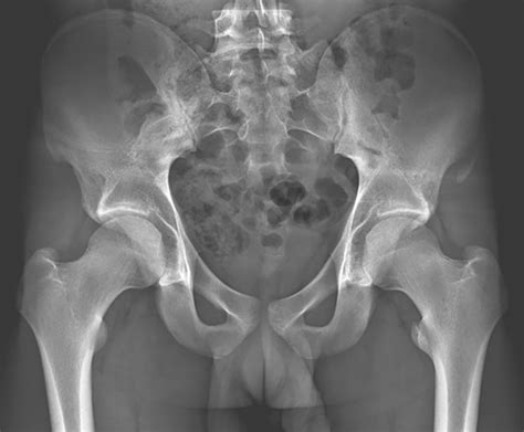 Pelvic Avulsion Injuries In The Adolescent Athlete Musculoskeletal Key