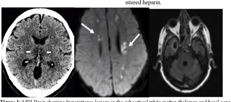 Figure 1 From The Severe Acute Hemorrhagic Necrotizing Encephalopathy