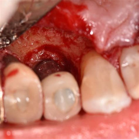 Surgical Photograph Showing Bone Loss Around The Infected Dental
