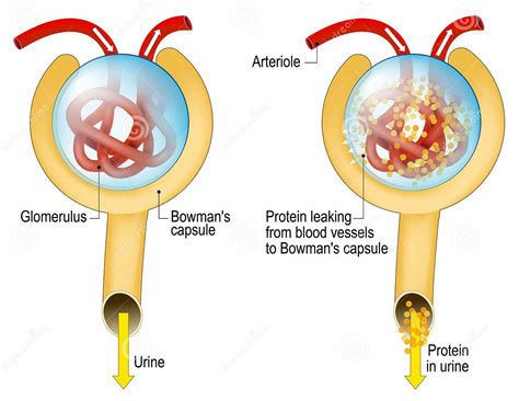 Diabetic Nephropathy Medtour