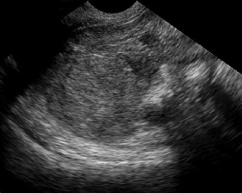 Primary Extrauterine Ovarian Choriocarcinoma Mistaken For Ectopic