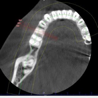 CBCT Depicting Panoramic View Panoramic View Showing Root Piece With