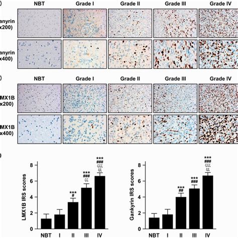 Higher Gankyrin And LMX B Expression Levels Were Associated With Worse Download Scientific