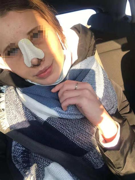 Ent Clinical External Nasal Thermoplastic Splint For Nose Fracture