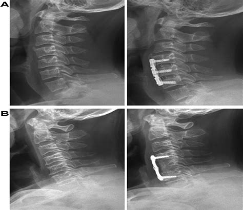 Two Level Anterior Cervical Discectomy Versus One Level Corp Spine
