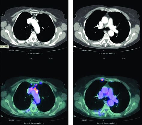 Baseline Positron Emission Tomography Computed Tomography Pet Ct