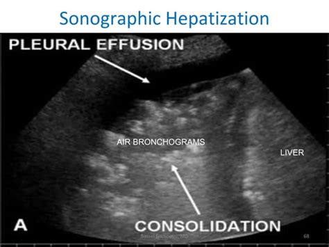 Ultrasonography Fundamentals In Critical Care Lung Ultrasound Pleural