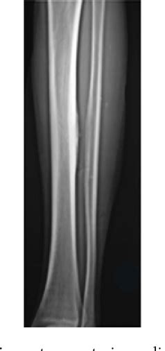 Pdf Ossification Of The Interosseous Membrane Of The Leg In A Football Player Case Report And