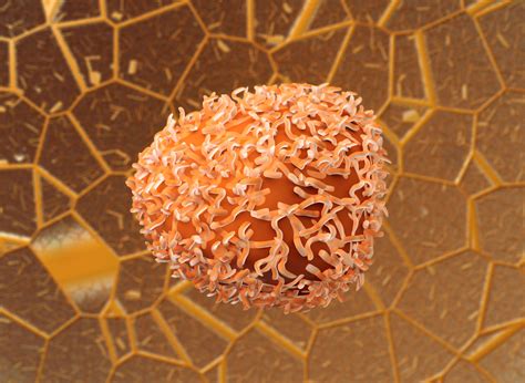 Why Is Colon Cancer So Common YourCareEverywhere