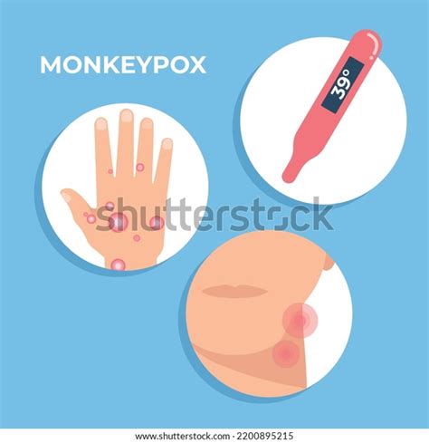 Monkeypox Signs Symptoms Vector Stock Vector Royalty Free 2200895215