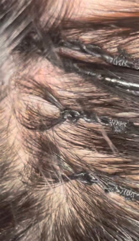 붙임머리 두피 지식in