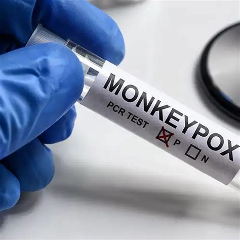 Monkeypox Virus Pcr Test Near You In Delhi Book Test At Low Price