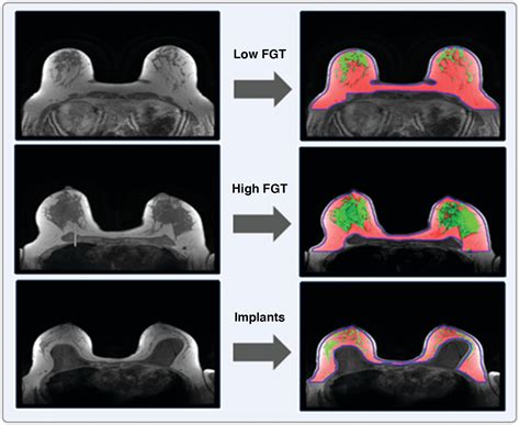 Quantitative Measures Of Background Parenchymal Enhancement Predict