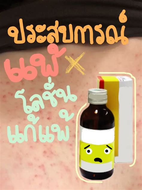 ก็เรามันไอขี้แพ้ซะด้วยสิ แพ้โลชันแก้แพ้ไปเลยยยยย🥹 แกลเลอรีที่โพสต์โดย