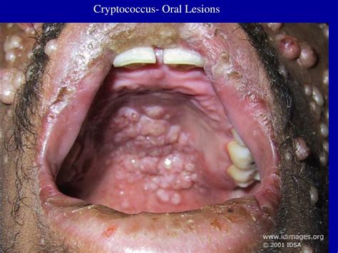 Ppt Cryptococcus Neoformans And Other Yeast Powerpoint Presentation Free Download Id 6773808