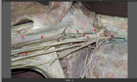 Brachial Plexus Cadaver Diagram Quizlet