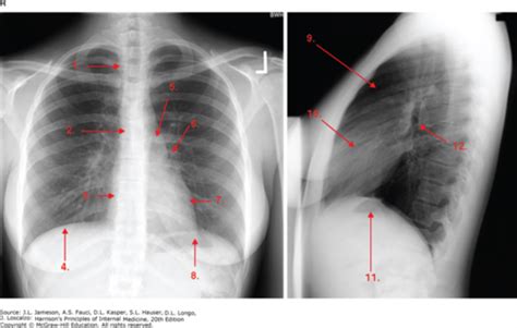 Restrictive Lung Diseases Emphasis Extrinsic Flashcards Quizlet