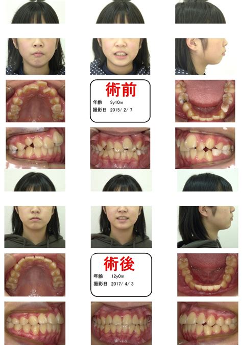 9歳女の子 八重歯｜三重県伊賀市の矯正歯科