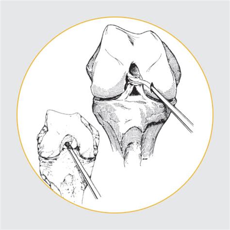 Arthroscopy ACL PCL I Surgical Innovative Surgical Supplies