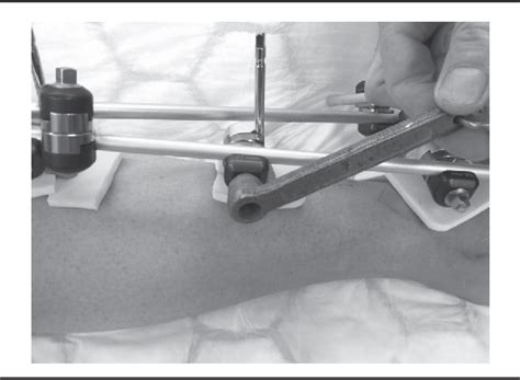 Figure 1 From Use Of A Femoral Impaction Grafting System In Revision