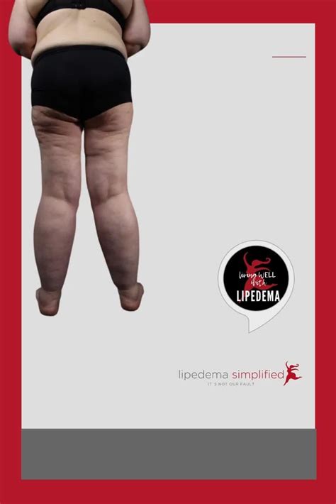 What Is Lipedema Lipedema Simplified Artofit