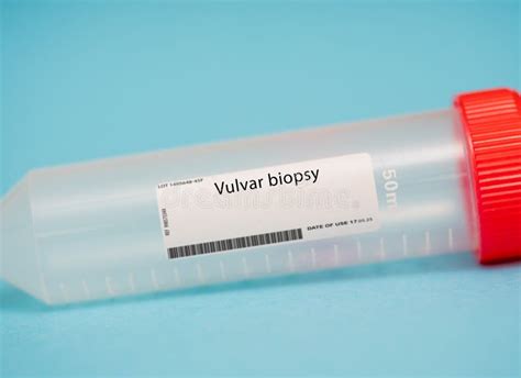 Vulvar Biopsy Stock Image Image Of Checkup Vaginalis 275972457