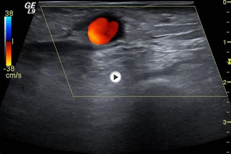 After 30 Minutes Of Ultrasound Guided Compression There Is No Evidence Download Scientific