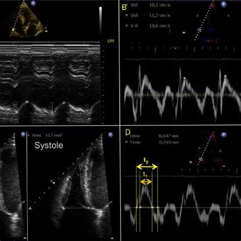 Reproducibility Of Echocardiographic Parameters To Assess RV Systolic Download Table