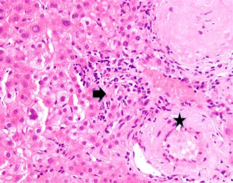 vasotropic light chain amyloidosis and ischaemic cholangiopathy pmc