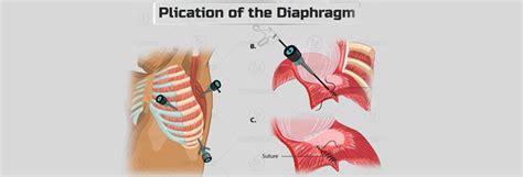 Diaphragmatic Plication