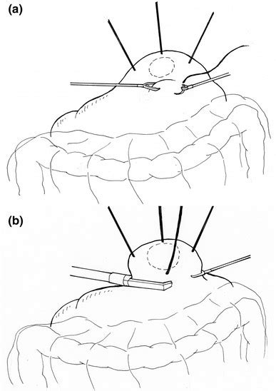 The Non Touch Lesion Lifting Method For Laparoscopic Local Resection A