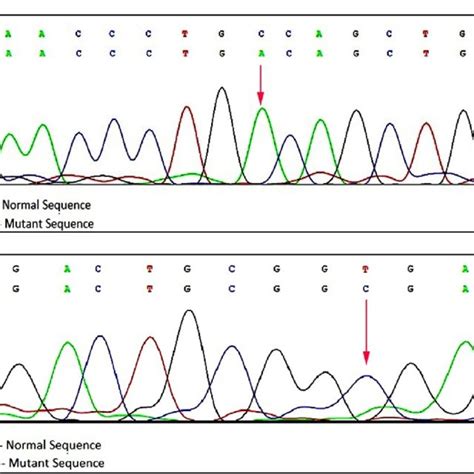 Sequencing Of The NPC Genes A Chromatogram Showing Homozygous Nonsense