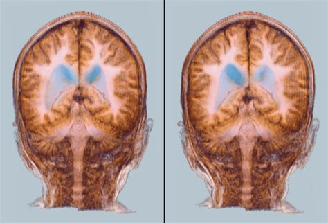 Enlarged Ventricles 1d By Voxel123 On Deviantart