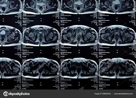 Cairo Egypt November 2023 Mri Hip Joint Showing Bilateral Femoral