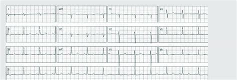 Transthoracic Echocardiogram Demonstrating Apical Ballooning Of The Download Scientific Diagram