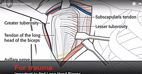 The Deltopectoral Approach Explained —