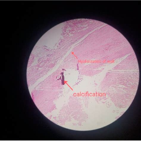 Histopathological Picture Showing Calcification Of The Gall Bladder
