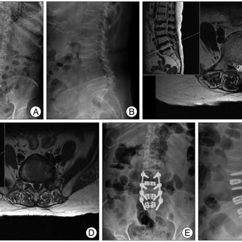Images Obtained During Percutaneous Epidural Neuroplasty A It Was