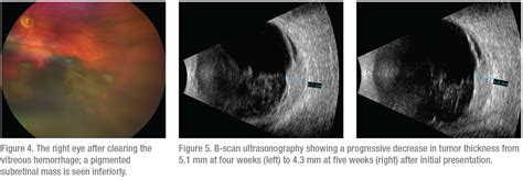 Choroidal Hemorrhage
